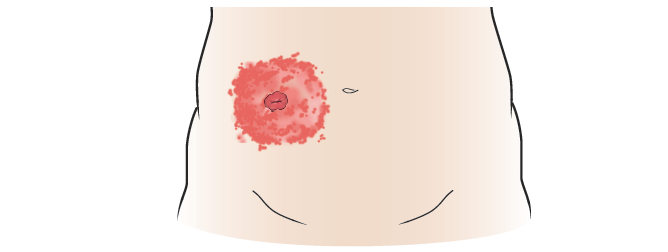 What could be the cause of stoma pain?