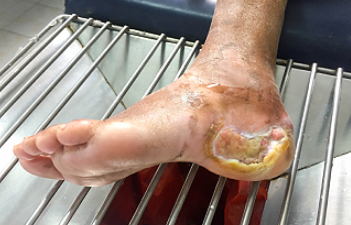 Wound Knowledge: Eschar and Slough