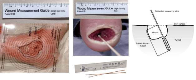 5 Ways to Measure a Wound
