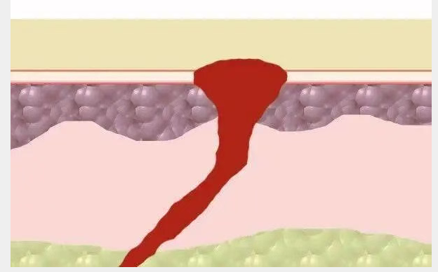How long does it take for a sinus tract to heal after surgery?