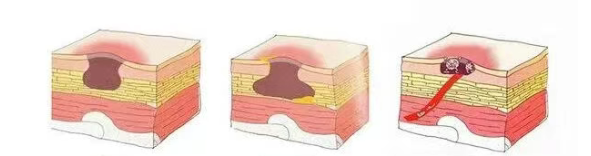 The difference between sinus tract and undercover