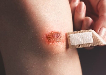Should you peel off the scab when a wound is healing?